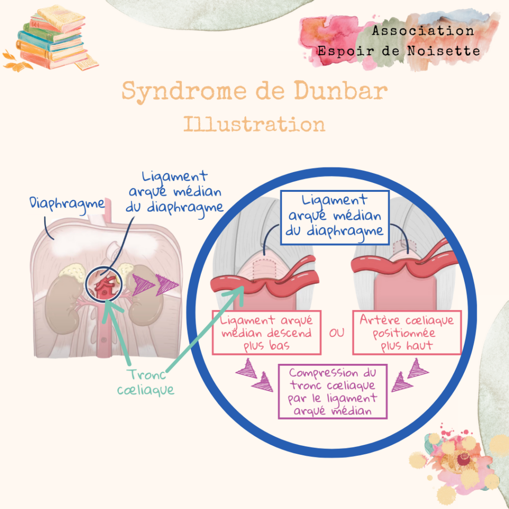 Syndrome de Dunbar – Association Espoir de Noisette