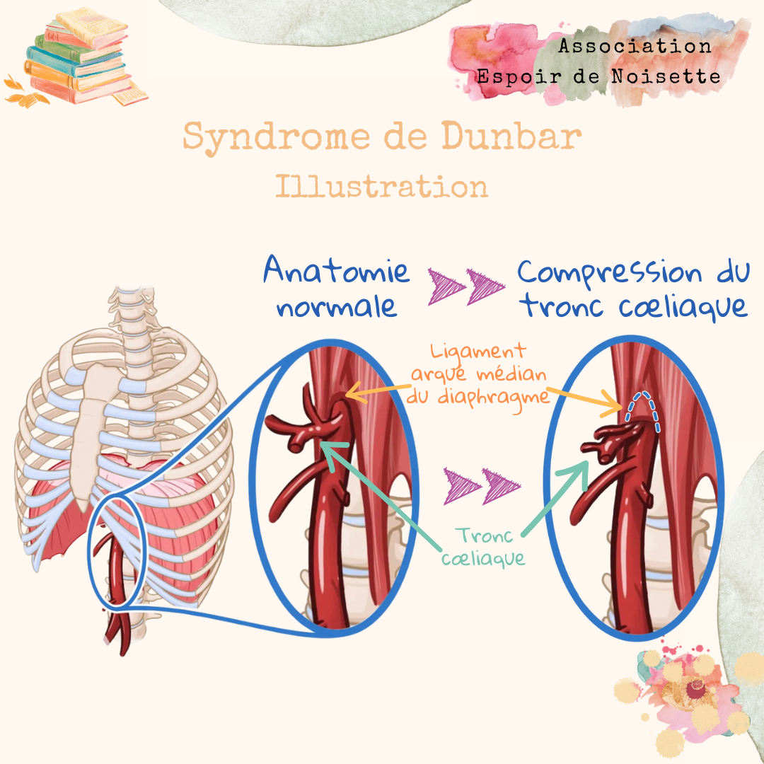 Syndrome de Dunbar – Association Espoir de Noisette