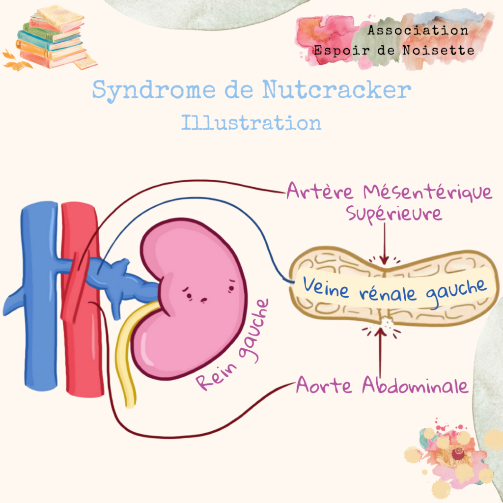 Syndrome de Nutcracker – Association Espoir de Noisette
