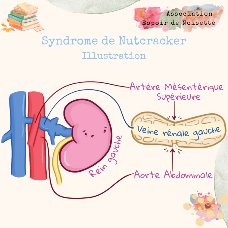 Syndrome de Nutcracker – Association Espoir de Noisette