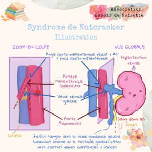 Syndrome de Nutcracker – Association Espoir de Noisette
